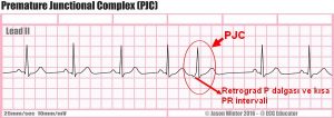 Prematüre Junctional Kompleks (PJC) | Resüsitasyon